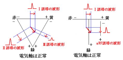 心電図：左軸偏位とは 右軸偏位とは