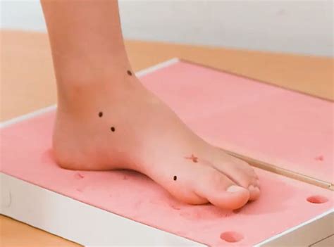 Manejo clínico y toma de molde en el pie plano infantil Fixtoe Academy