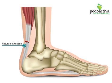Rotura del tendón de Aquiles y tendinopatías tendinitis y tendinosis