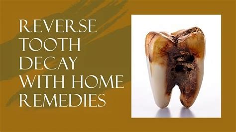 How To Reverse Tooth Decay With Simple Home Remedies