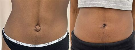 Belly Buttons Innie Vs Outie
