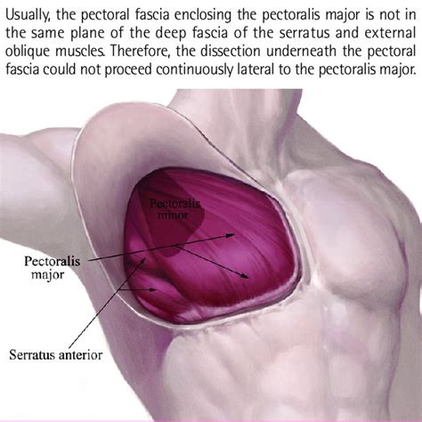 Subfascial Dissection Download Scientific Diagram