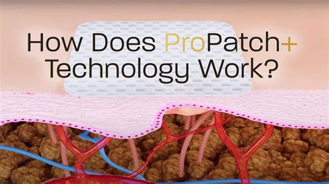 Patch Technology Propatch