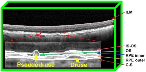 Illustration Of The Multiple Layer Segmentation Including The Rpd And Download Scientific