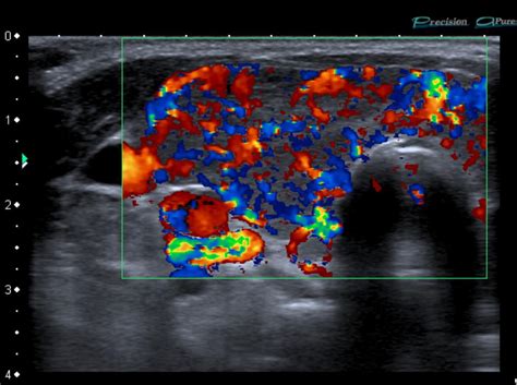 What Does A Graves Disease Thyroid Look Like On Ultrasound At Troy