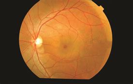 Central Serous Chorioretinopathy Patients The American Society Of