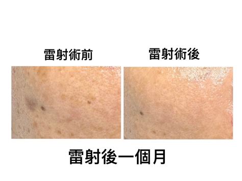 分享 雷射是斑的救星 獻上我第一篇分享文 醫美板 Dcard