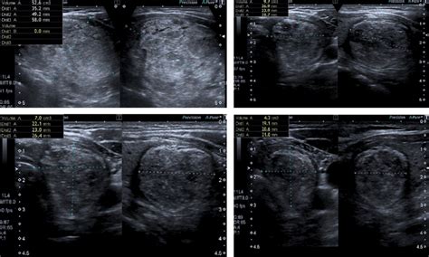 28 Years Old Male Patient With A Solid Nodule In The Left Thyroid Lobe