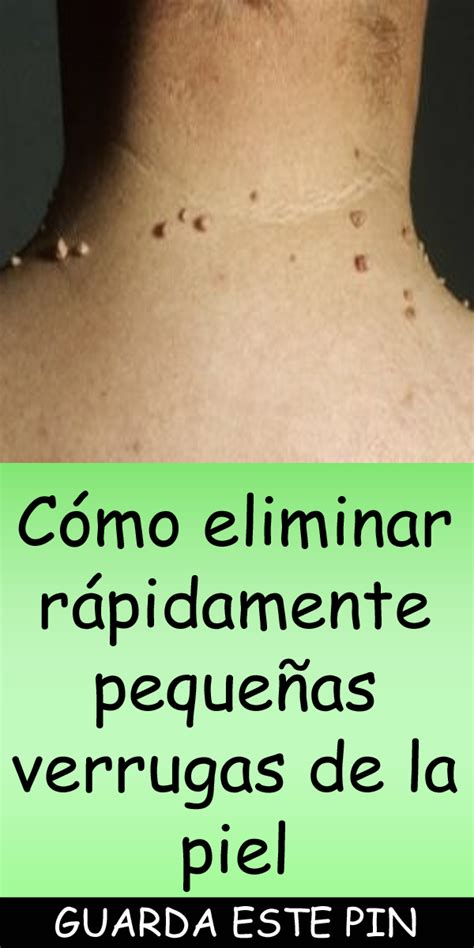 use a pasta de dente desta maneira para remover verrugas b9f 2024