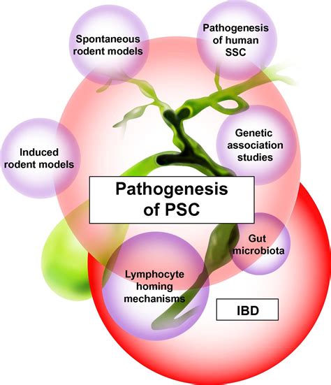 Update On Primary Sclerosing Cholangitis Journal Of Hepatology