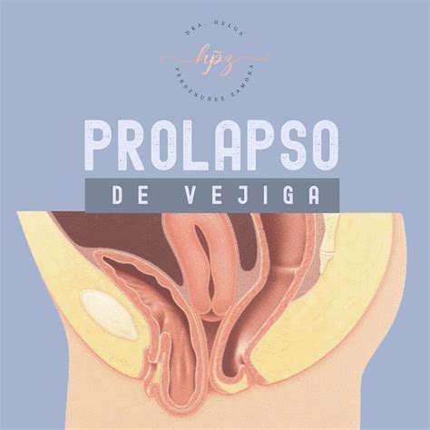 Pin En GinecologÍa