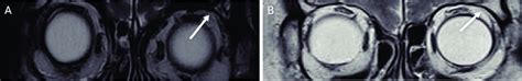 Representative Magnetic Resonance Imaging Findings Of A Sagging Eye