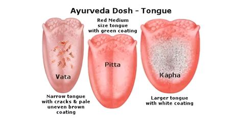 Ayurvedic Tongue Diagnosis Birla Ayurveda