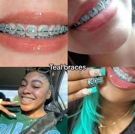 Teal Braces Smiley Piercing And Braces Lavender And Teal Braces