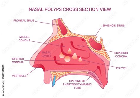 Labeled Nasal Polyps Cross Section Diagram Nasal Cavity Sinuses