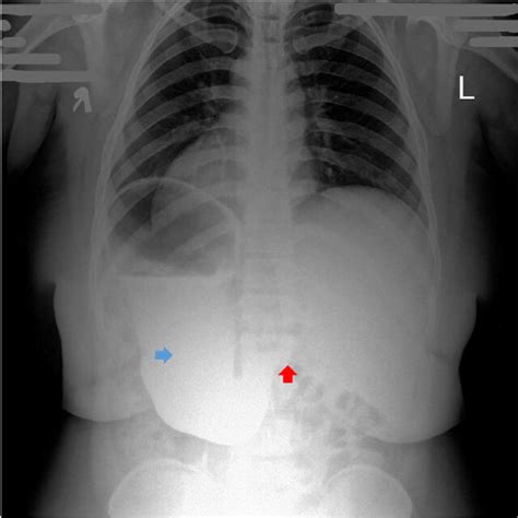 Barium Meal Radiograph Showing A Right Sided Stomach Blue Arrow With Download Scientific