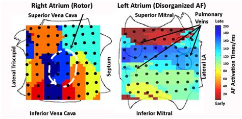 Mapping Localized Sources In A 66 Year Old Gentleman With Persistent Afib Despite Prior Ablation