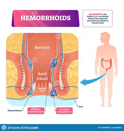 Hemorrhoids Vector Illustration Labeled Anatomical Vascular Piles