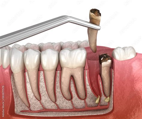 Complex Tooth Extraction Medically Accurate 3d Illustration Of Dental