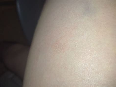 Шелушащейся пятна Вопрос детскому дерматологу 03 Онлайн