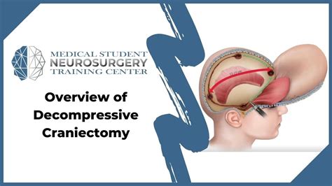 Overview Of Decompressive Craniectomy Youtube
