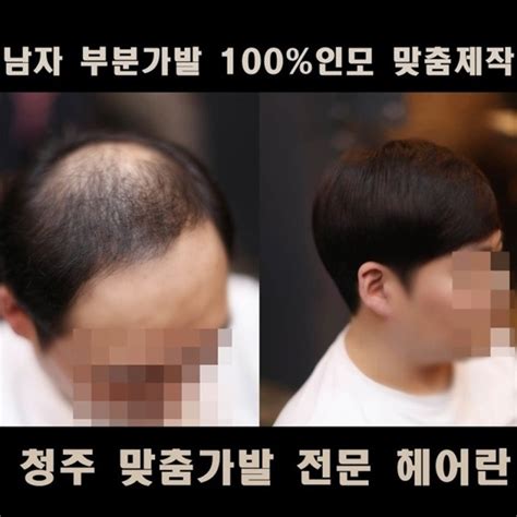 남자 맞춤가발 정수리 탈모 해결 네이버 블로그