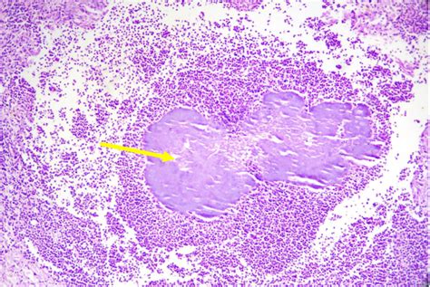 Sulphur Granules With Actinomyces Arrow Surrounded By Significant