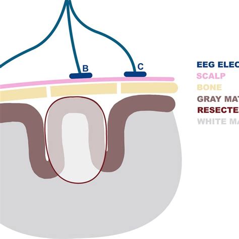 Scalp Eeg Recording Setup Following Epilepsy Surgery Position Of The