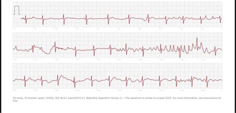 Artifact Or Something Else R Pvcs