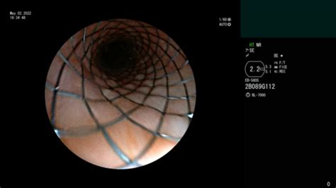 Lecture 49 Trachea Surgery Flashcards Quizlet