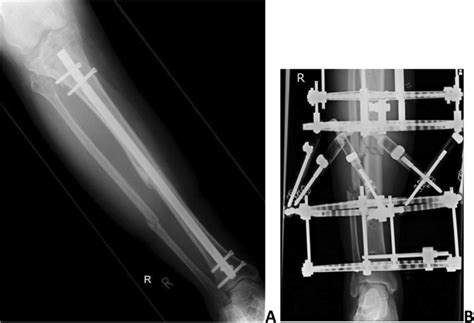 A Radiograph Showing Segmental Tibial Fracture Fixation With Imn B