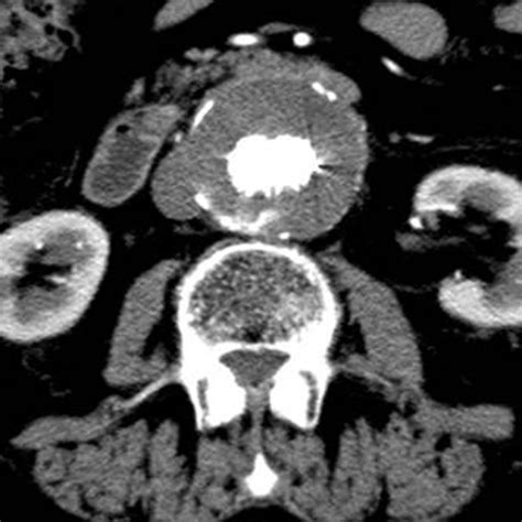 Embolization Of A Type Ii Endoleak From The Ileo Lumbar Branch Of The