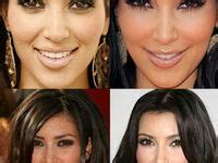 Before And After Plastic Surgery Ideas Plastic Surgery Surgery Celebrity Plastic Surgery