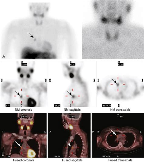 Guide To Preoperative Parathyroid Localization Testing Ento Key