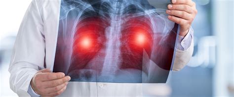 Chest Diseases Özel Mersin Akademi Hastanesi Sağlıkta Güven