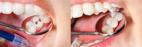 Composite Fillings All You Need To Know