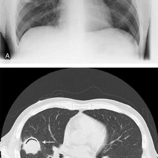 Tree In Bud Sign Multiple Peripheral Bud Like Opacities Arrow In A