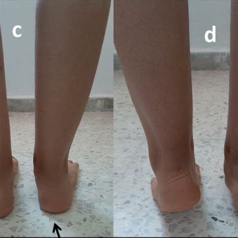 A Medial Arch Foot Collapse With Scare In Retromaleollae Ankle