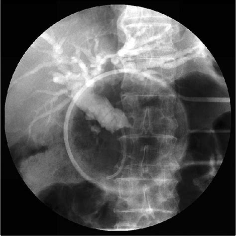 Endoscopic Retrograde Cholangiographic Findings A Filling Defect Was Download Scientific