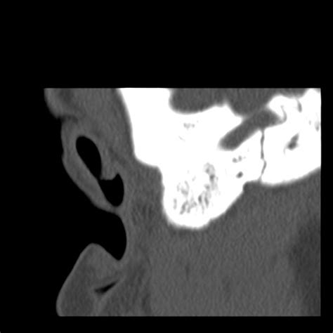 Normal Temporal Bone Ct With Annotated Images Radiopaedia 84293 99584 Lt Poschl Nc Commons