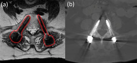 A Mri And B Ct Scans Showing Artefact Generation From Titanium Screws Download Scientific Diagram