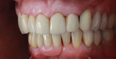 Cosmetic Crowns And Precision Partial Dentures Northland