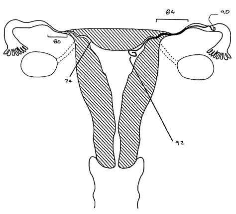 Patents Fallopian Occlusion Tube Sketch Coloring Page