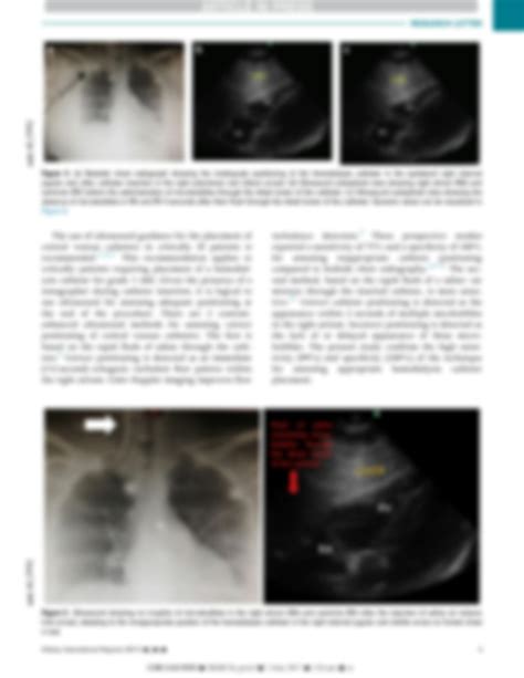 Solution Agitated Saline Bubble Enhanced Ultrasound For Assessing