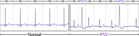 Evaluating Feature Attribution Methods For Electrocardiogram Deepai
