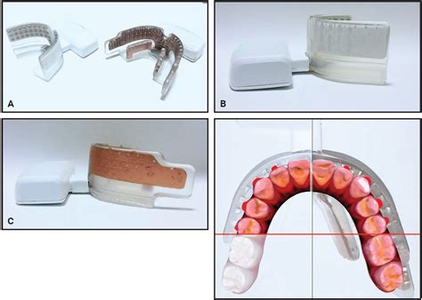 Accelerated Upper Molar Distalization Aligner Treatment