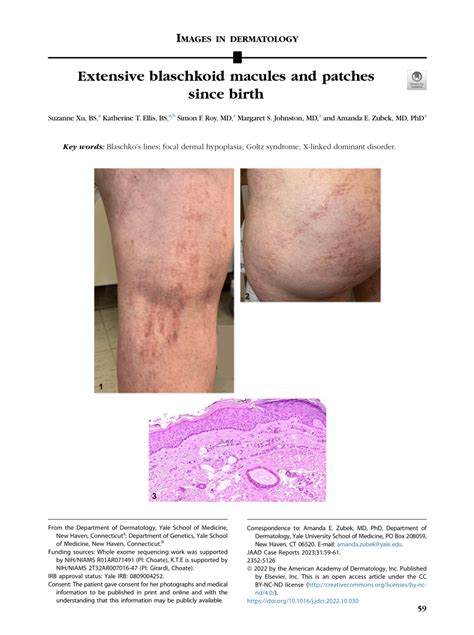Pdf Extensive Blaschkoid Macules And Patches Since Birth