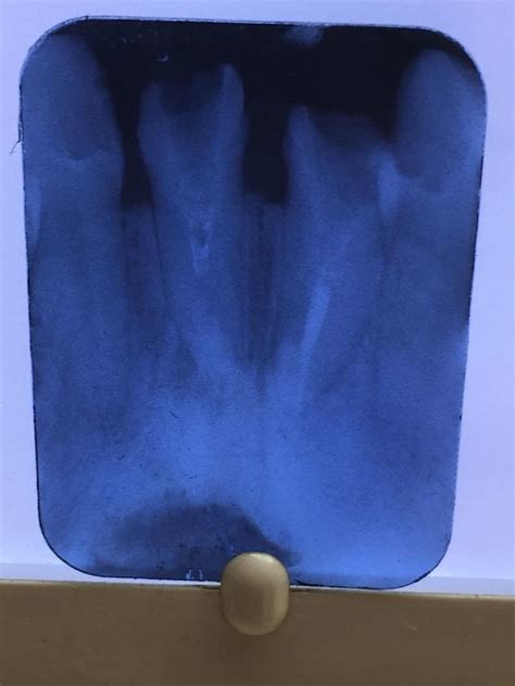 上前牙残根 医联