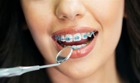 Braces May Be Needed Even If You Have Straight Teeth Philadelphia PA