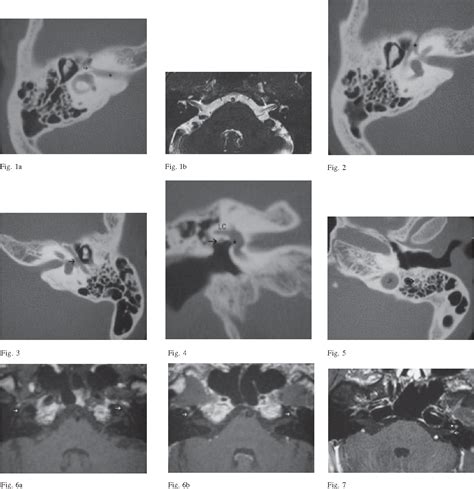 Abnormality Of The Cranial Nerves Semantic Scholar